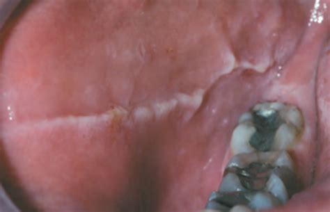 Cheek Biting News Dentagama
