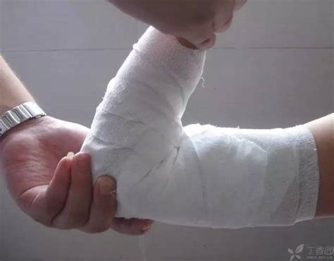 7周岁儿童肱骨髁上骨折手术后多长时间取钉合理 儿子七岁右手肱骨髁上骨折手术治疗克氏钉固定