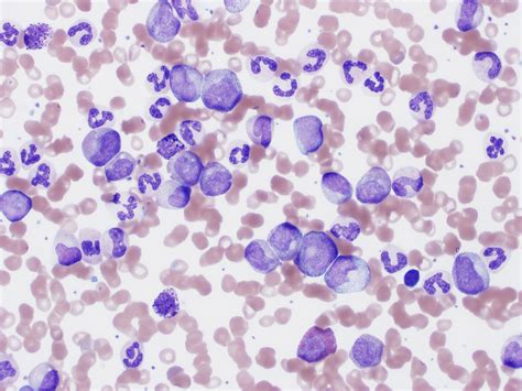 Sarcoma What We Know About This Type Of Cancer