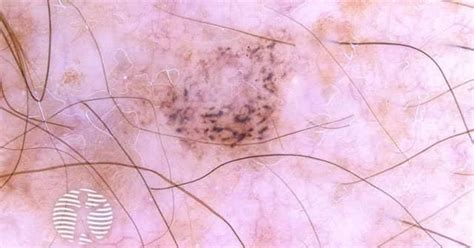 Lichenoid Keratosis Image