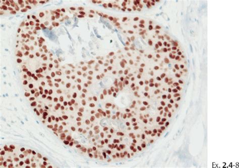 Group 1 One Or Two Clusters Of Crushed Stone Like Calcifications Of The Mammogram Produced By