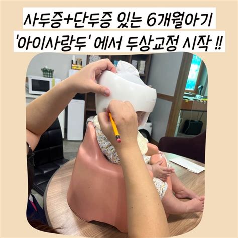 사두증 단두증아기 대구아기두상교정 아이사랑두 칠곡점교정헬멧 시작 네이버 블로그