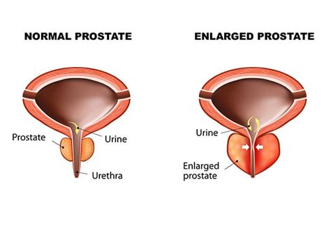 Prostate Artery Embolization Miami Fl Call 305 504 8667