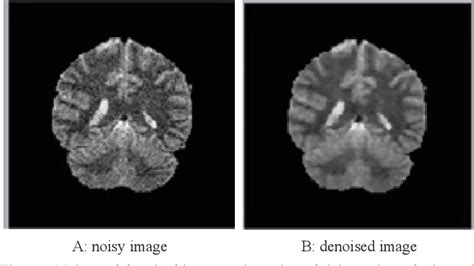 Figure 1 From An Improved Classification System For Brain Tumours Using Wavelet Transform And