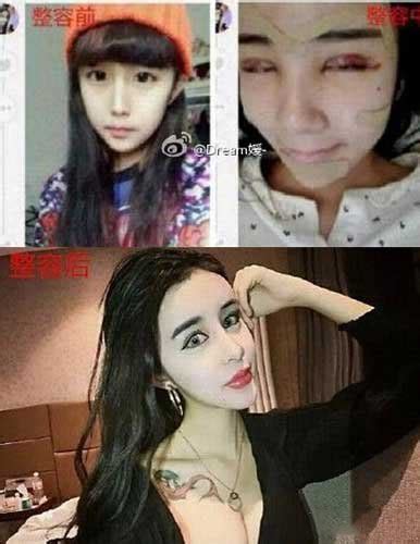 蛇精女李蒽熙整容前后 15岁少女丰胸多处整形惊呆了