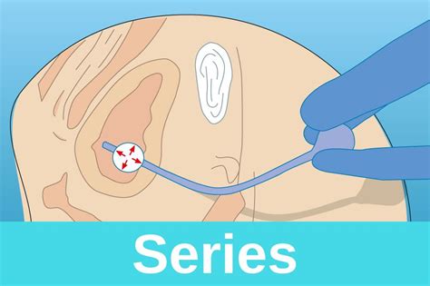 What Size Of Foley Catheter Is Commonly Used For Surgery