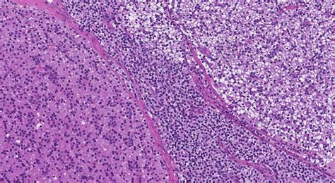 Parathyroid Hyperplasia Atlas Of Pathology