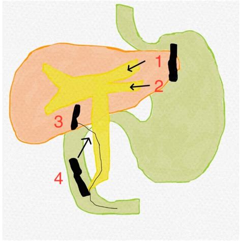 Eus Guided Biliary Drainage Methods Antegrade Stenting And Download Scientific