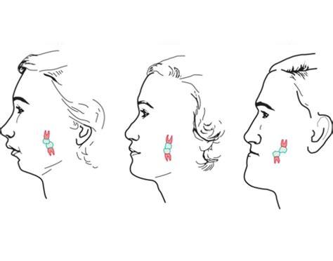 Malocclusion Classification Quiz
