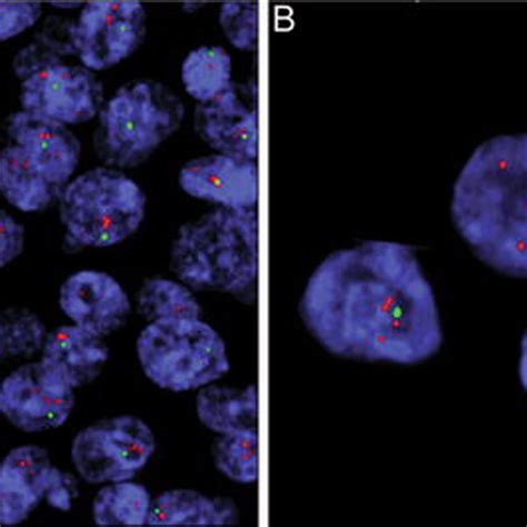 Correlation Of Her2 Expression By Ihc Versus Fish Ratio In