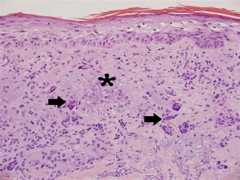 Annular Elastolytic Giant Cell Granuloma Dermatology Advisor