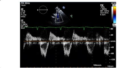 Transthoracic Echocardiography Suprasternal View With Pulsed Doppler Download Scientific
