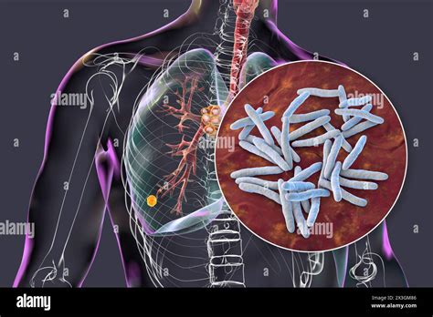 Illustration Of Primary Lung Tuberculosis With The Ranke Complex