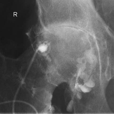 Radiographs Of Injection And Hip Arthroplasty The Anteroposterior