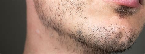 Beard Alopecia Causes And Treatments