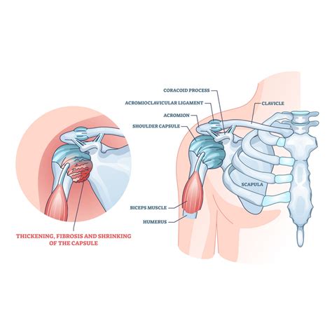 Trigger Point Therapy Treating Pectoralis Major Artofit