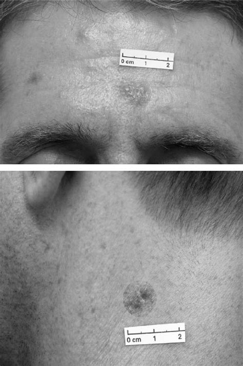 Characteristic Nodular Lesions Download Scientific Diagram