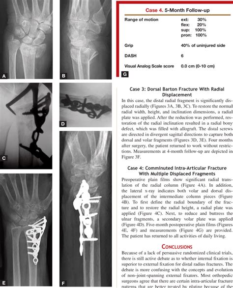 A B Comminuted Intra Articular Fracture Displacement Of The Radial Download Scientific