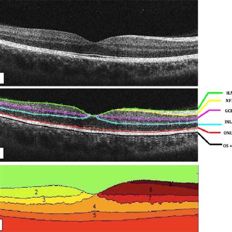pdf differential vulnerability of retinal layers to early age related macular degeneration