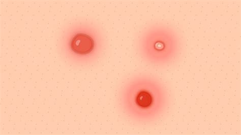 Blackhead Under Microscope