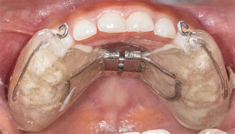 Jaw Growth Modification Techniques And Appliances