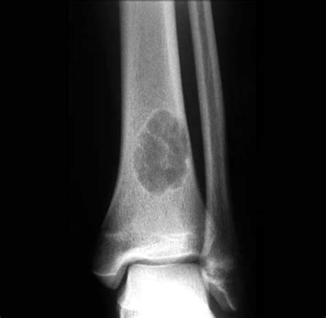 Diagnostic Week 4 Fibrous And Miscellaneous Tumours Flashcards Quizlet