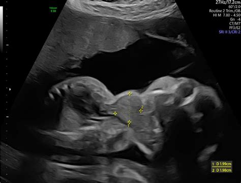 Figure 3 From Maternal Graves Disease Postthyroidectomy With Fetal Thyrotoxicosis And Goiter