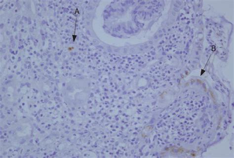 Cytomegalovirus Colitis In A Patient With Behcets Disease Receiving
