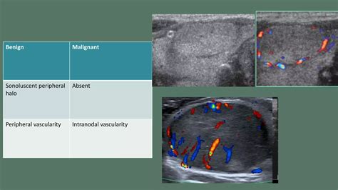 Imaging Of Thyroid PPTX Thyroid Disorders Endocrine And Metabolic Diseases