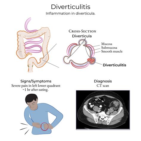 Clinical Pathology Glossary Diverticulitis Ditki Medical And Biological Sciences