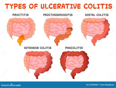 Ulcerative Colitis Types Gut Disease Intestine Inflammation From Proctitis To Pancolitis