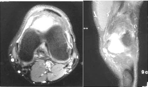 Figure 3 From Ganglion Cyst Of Hoffas Fat Pad Of Knee A Rare Cause Of