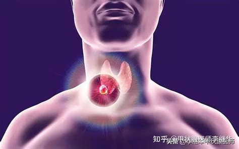 甲状腺结节怎么中医治疗？ 知乎