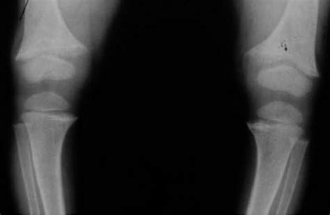 A Clinicians Guide To X Linked Hypophosphatemia Pmc