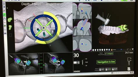 Dynamically Guided Endodontics YouTube
