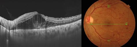 Diabetic Macular Edema Retina Center Tijuana