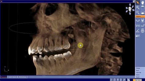 Radiographic Interpretation Of Mandibular Condyle Fracture Youtube