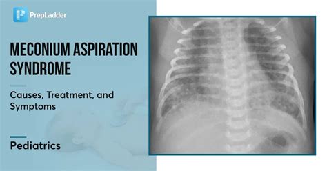 Meconium Aspiration Syndrome X Ray Chest X Ray Consistent With