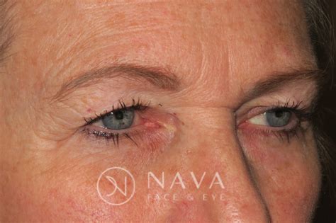 Browplasty Before And After Photos Nava Face And Eye
