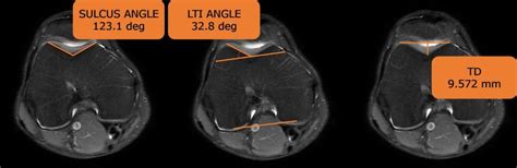 The Analyzed Patient Presents A Normal Trochlear Surface Download Scientific Diagram