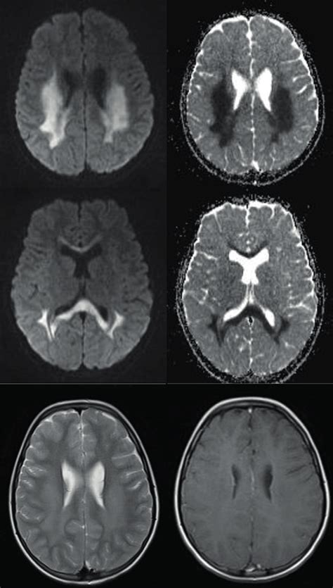 Bilateral Diffusion Restriction In Parietal White Matter Splenium And