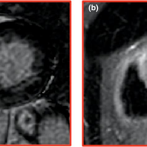 Ecg At One Year Reoccurrence Of Left Bundle Branch Block Morphology Download Scientific