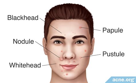 What Is An Acne Pustule