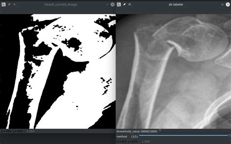 Python Image Threshold Algorithms To Use On An X Ray Image And Detect Bones Stack Overflow