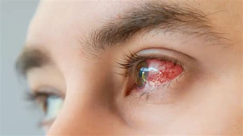 Keratitis Vs Uveitis What Is The Difference