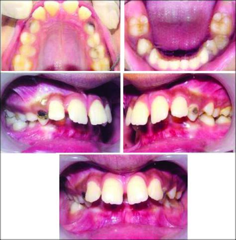 Early Intervention In Skeletal Class Ii And Dental Class Ii Division I