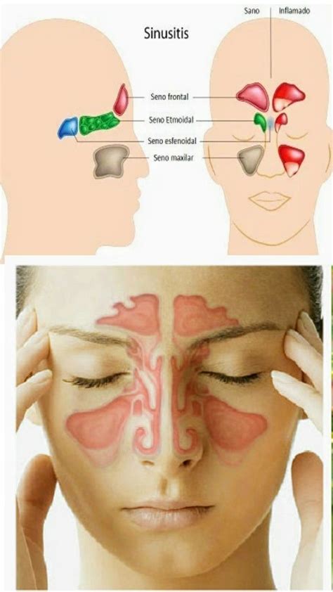 Sinusitis Ubicación