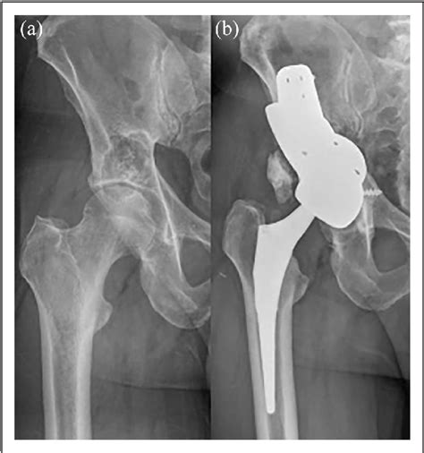 Figure 3 From Trabecular Metal Augments In Severe Malignancy Associated