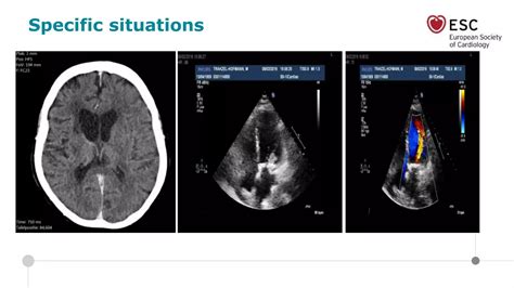 Esc Guidelines Endocarditis By Prof Deldago Pptx