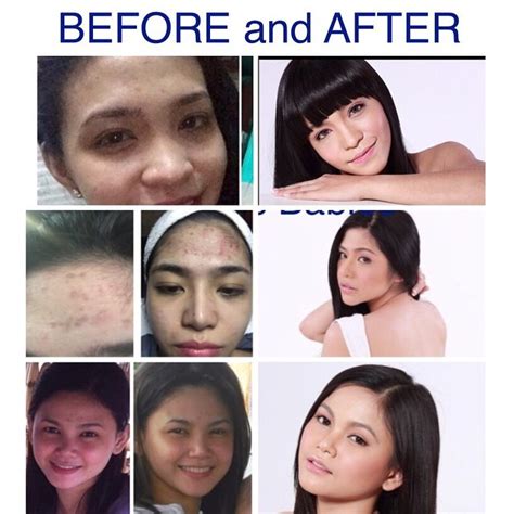Glutathione Vitamin C Injection Before And After At Danita Foster Blog